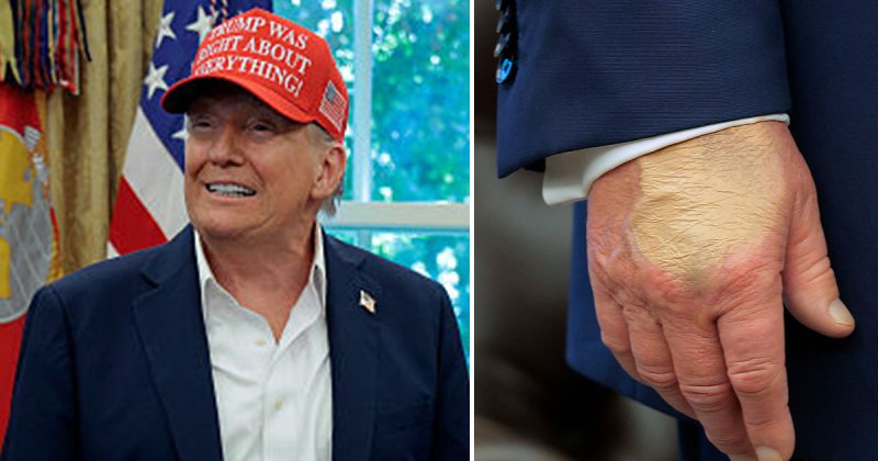 Alarming photo of Trump’s hand sparks deep concern | News22
